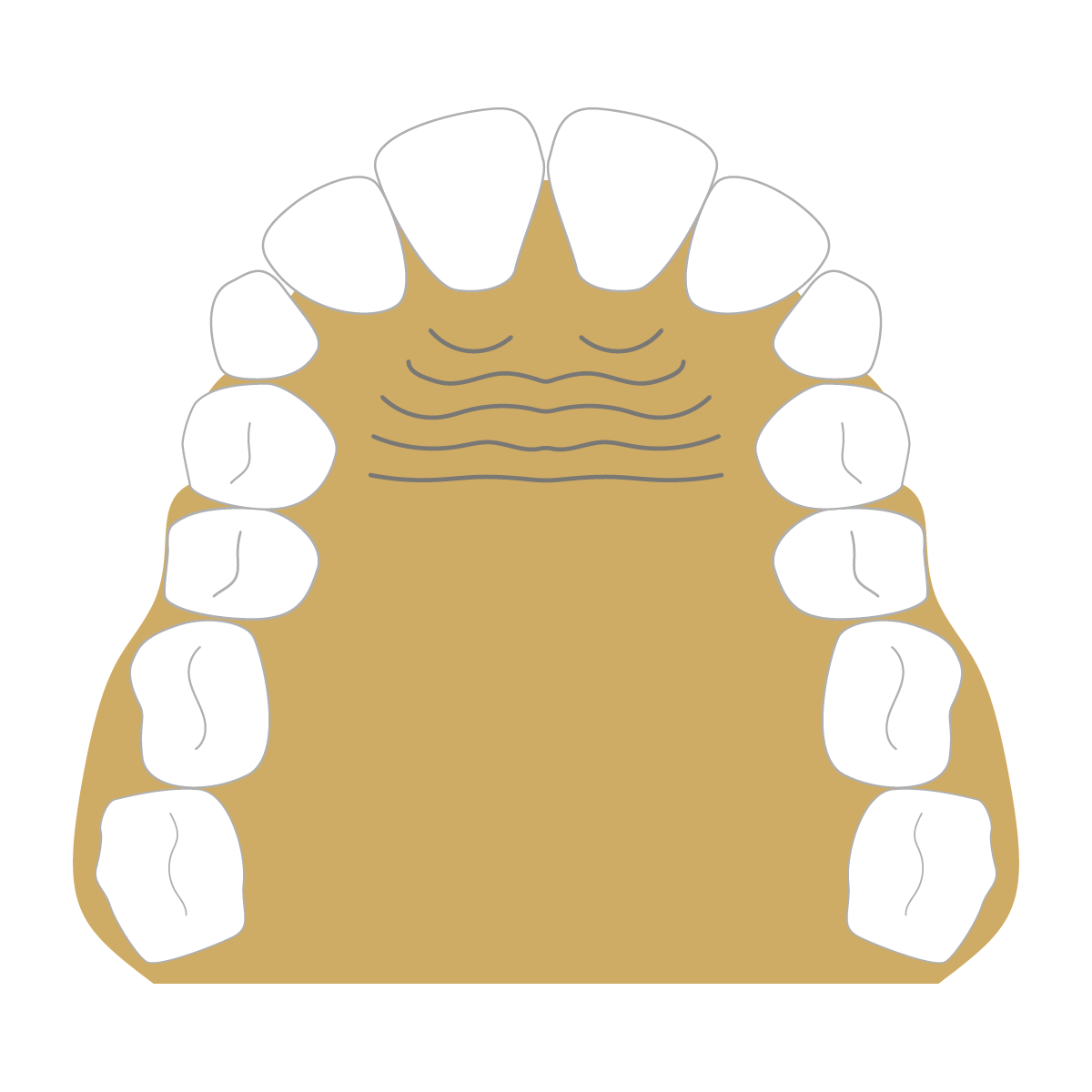 Narrow Upper Jaw - Austin Orthodontics