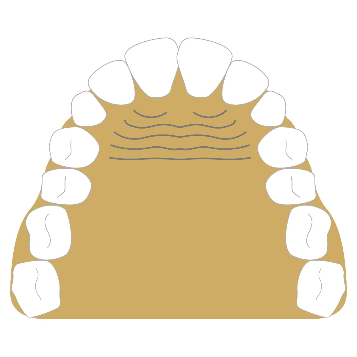 Narrow Upper Jaw - Austin Orthodontics