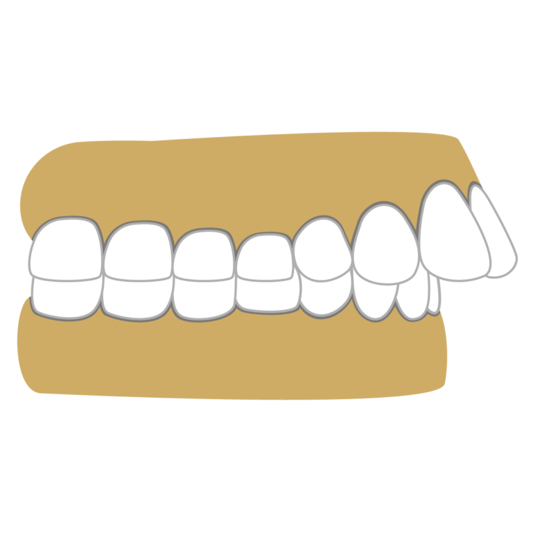 Overbite and Overjet - Austin Orthodontics
