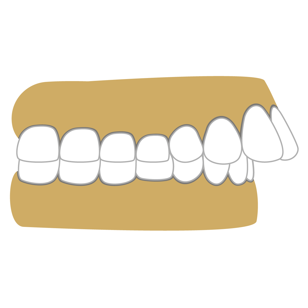 Overbite and Overjet - Austin Orthodontics