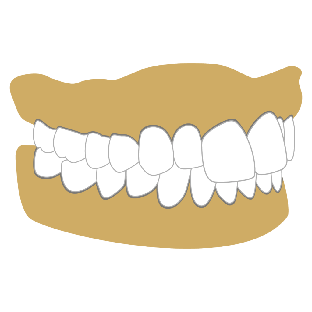 Protruding or Prominent Front Teeth - Austin Orthodontics